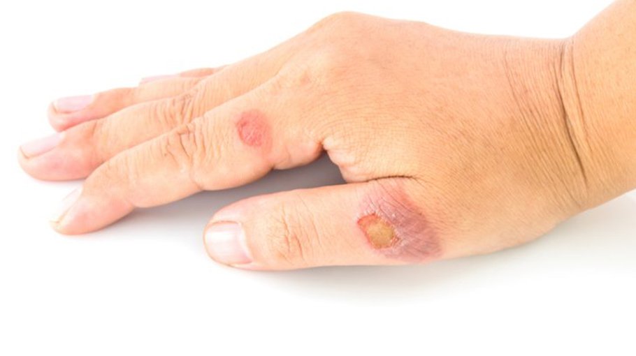 Pyoderma gangrenosum, its symptoms (part 1) - Bangladesh Post